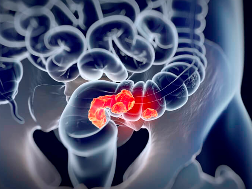 Dor no peito pode ser doença do esôfago e não do coração! - Clínica G2 ...